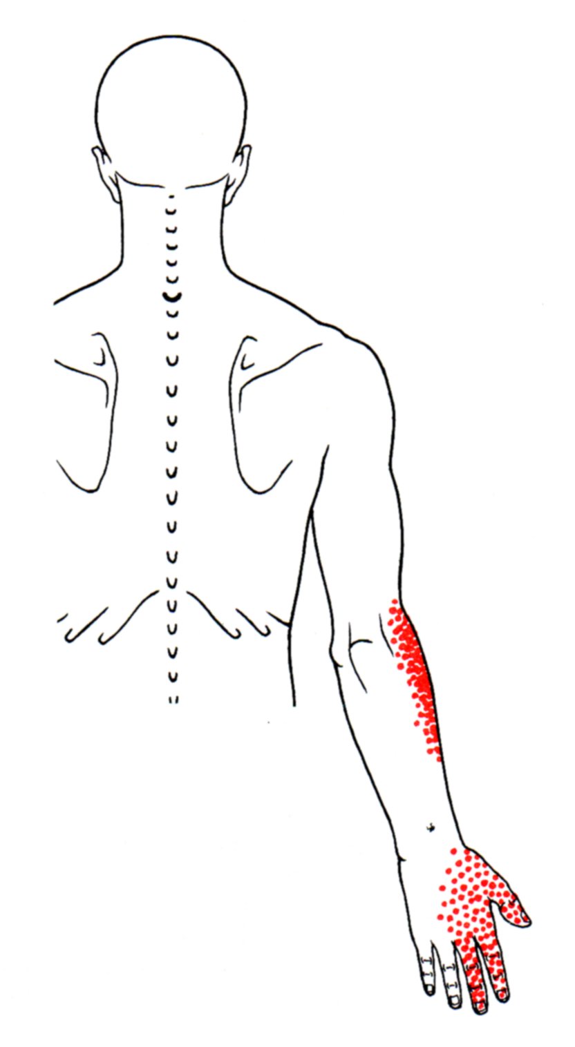 Subclavius Muscle Pain